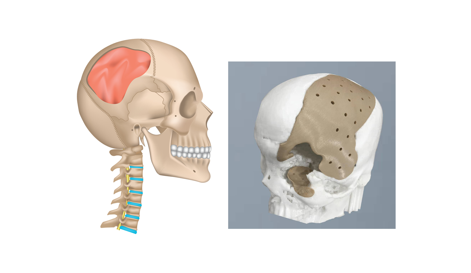 3D-Printed Training Models - ActivoCare